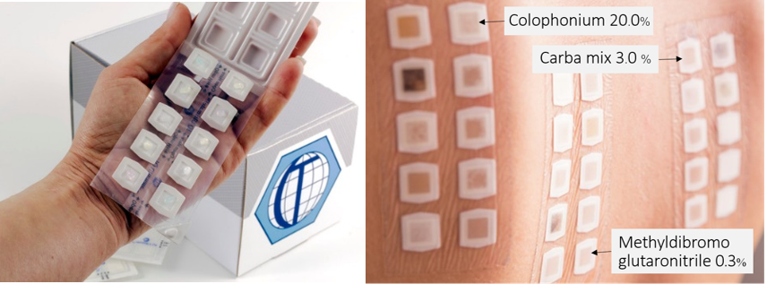 ทดสอบภูมิแพ้ผิวหนัง ชนิดแปะผิวหนัง | โรงพยาบาลขอนแก่นราม