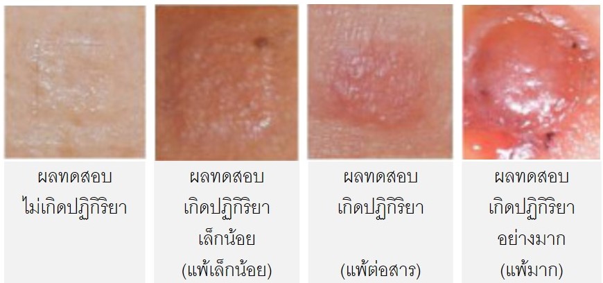 แพ็กเกจ : ทดสอบภูมิแพ้ผิวหนัง ชนิดแปะผิวหนัง | โรงพยาบาลขอนแก่นราม